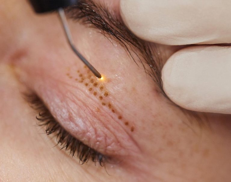 PlexR Plasma Pen - Allure Medical Aesthetics